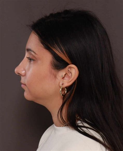 Deep Neck Contouring By Dr Manning Utah Facial Plastics