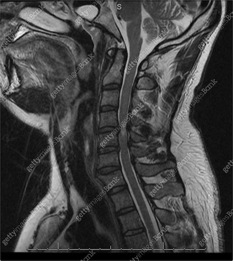 Mri Of Cervical Spinal Canal Stenosis 이미지 482300681 게티이미지뱅크
