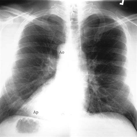 Dextrocardia