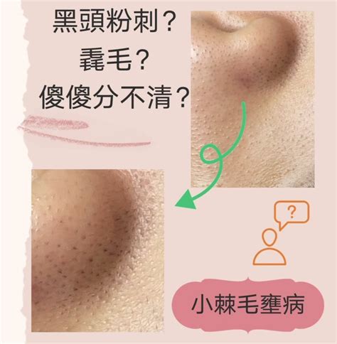 別被這‘假黑頭騙了！🤥 今天我們來認識一下《小棘毛壅症》 很多人看到鼻子上一點一點黑黑的 都會直觀的覺得是黑頭粉刺 可是近看卻是毳毛 先解釋