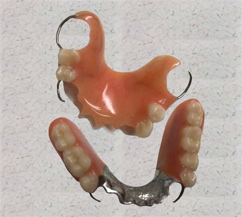 Removable Partial Denture Upper Removable Partial Dentures Baluke