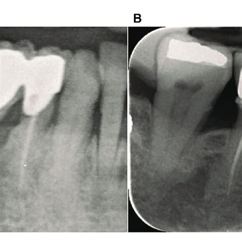 Radiographic Image Of The Lower Right Premolar Molar Region A