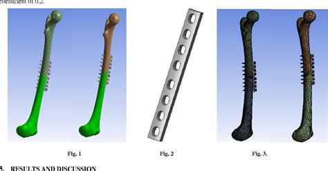 Figure 4 From Finite Element Analysis Of Femur Fracture Fixation Plates