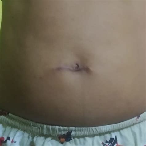 At 10 Months Follow Up With Well Defined Umbilicus Download