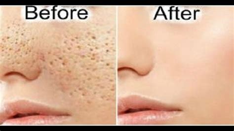 How To Reduce Pore Size TOP DIY