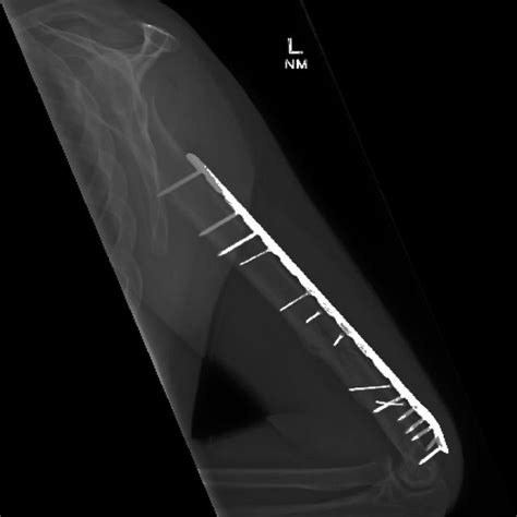 Bone Fracture Detection Object Detection Dataset V1 V1 By Veda