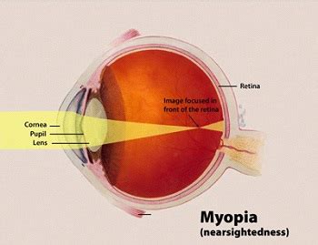 How To Correct Vision Problems