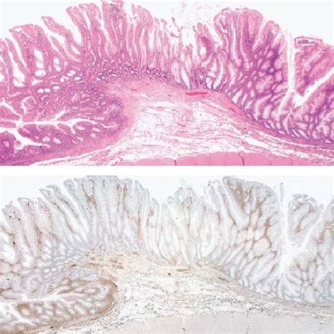 A Sessile Serrated Polyp Adenoma In Case 1 With Basal Crypt