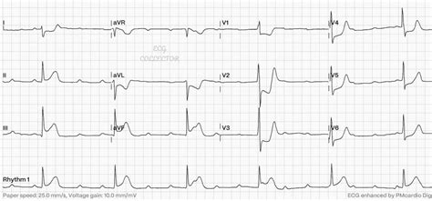 Inferior And Posterolateral Stemi Complete Av Block Junctional Escape