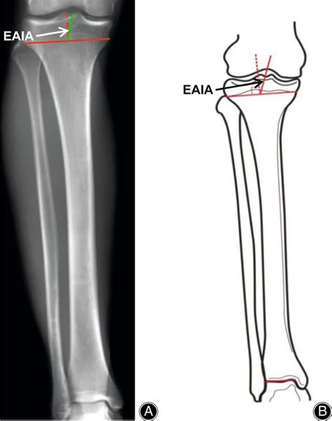 Eaia Is Defined As The Angle Between The Line Connecting The Midpoints