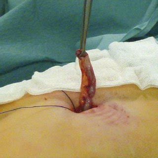 Mobilization Of Appendix And Cecum Download Scientific Diagram