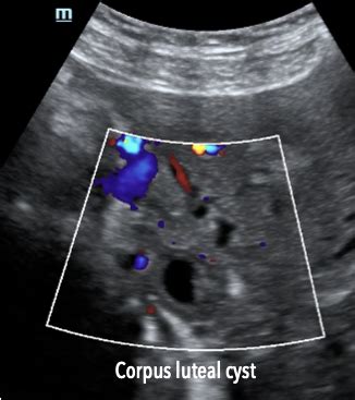 Intern Ultrasound Of The Month Complex Ovarian Cystic Lesions