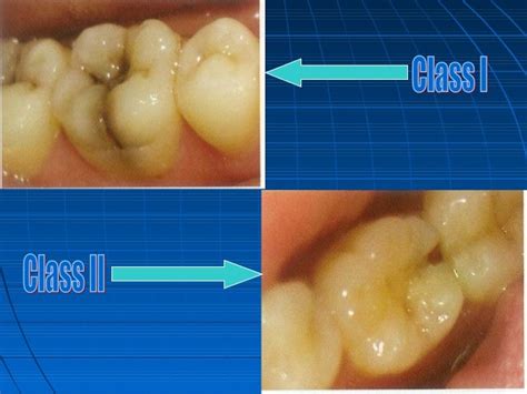 Dental Interproximal Caries