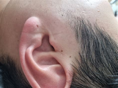 귀 주름 문의 지식in