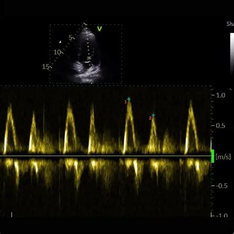 Interpreting Echocardiogram Results A Comprehensive Guide For