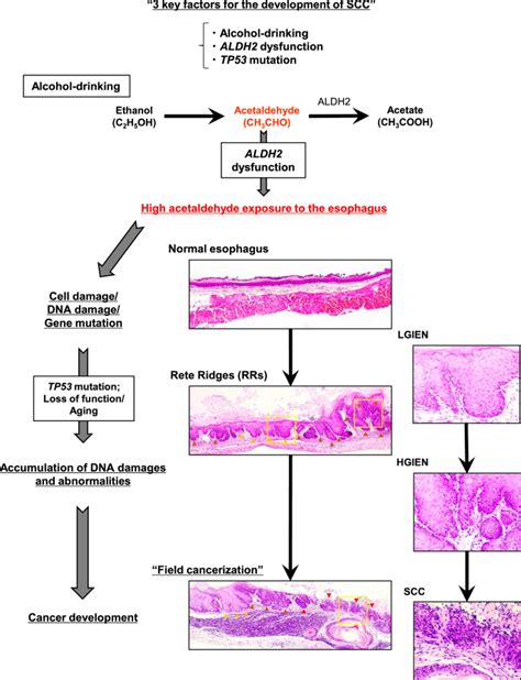 Aldh2 And The Tumor Suppressor Trp53 Play Important Roles In Alcohol