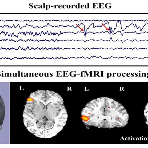 Localizing Epileptic Focus By Simultaneous Eeg Fmri Recording Mehran