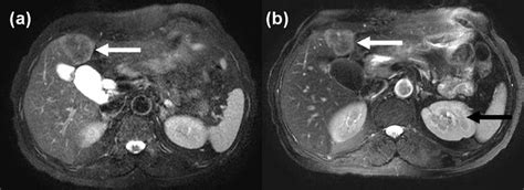 Multiple Hccs In A 62 Year Old Man A Large Hcc Is Visible On T2 And