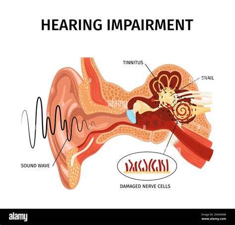 Realistic Anatomy Ear Tinnitus Composition With Sound Internal Organs