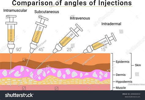Intradermal And Subcutaneous Injection Stock Vector