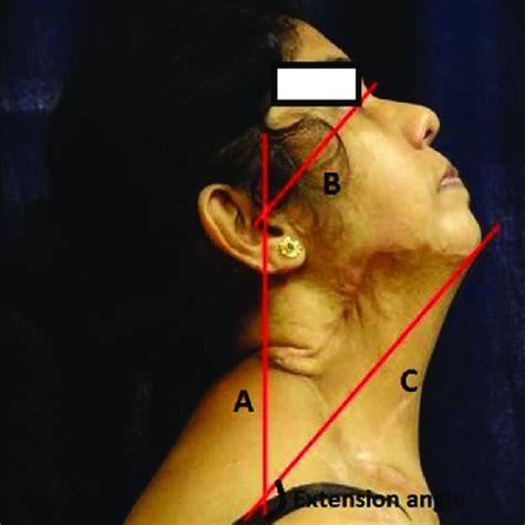 Extension Angle Measurement Download Scientific Diagram