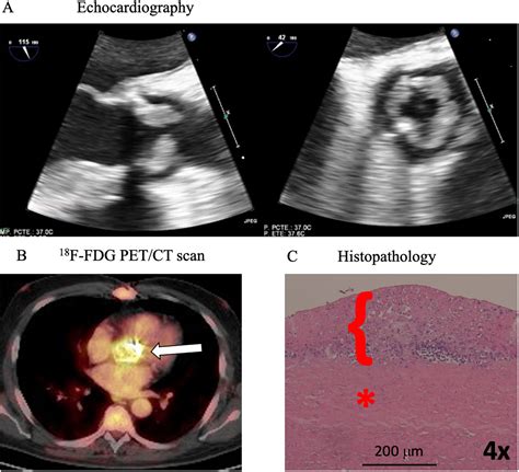 Valvulitis A New Echocardiographic Criterion For The Diagnosis Of Bioprosthetic Aortic Valve