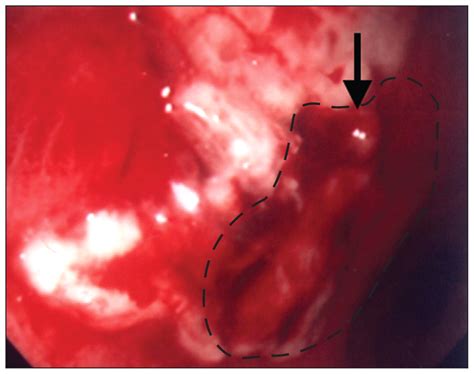 Figure 2 Lower Gastrointestinal Bleeding Caused By Stercoral Ulcer