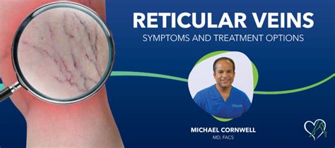 Reticular Veins Symptoms And Treatment Options