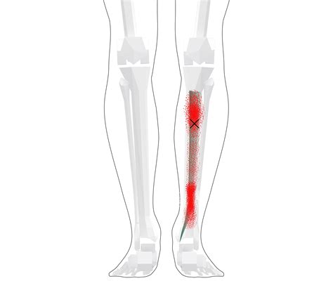Gluteus Minimus Trigger Points Overview Self Treatment Tips Gluteus Minimus Trigger Points Overview Self Treatment Tips