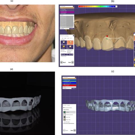 A Intra Oral View Of The Gingivectomy Guide In Place B Half Way Of The Download Scientific