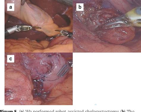 Figure 1 From Robot Assisted Laparoscopic Partial Gastrectomy Combined