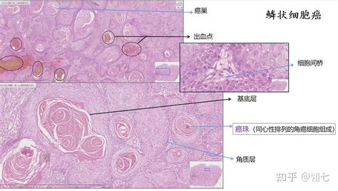 病理学实验报告 肿瘤1 知乎