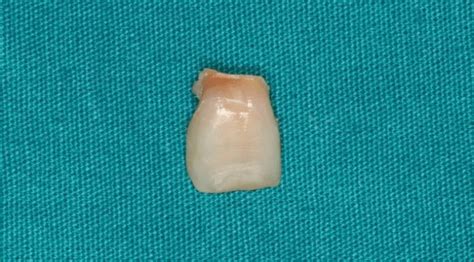 Buccal View Of The Detached Crown Root Fragment Download Scientific