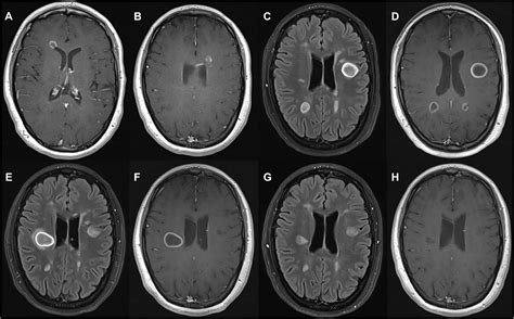Frontiers Case Report Tumefactive Demyelinating Lesions After The Second Cycle Of Alemtuzumab
