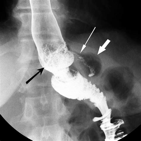 Gastric Bypass Intussusception Radiology At Juanita Morris Blog