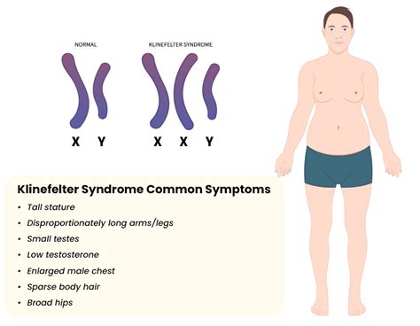 What Does Untreated Klinefelter Syndrome Look Like Healthkart