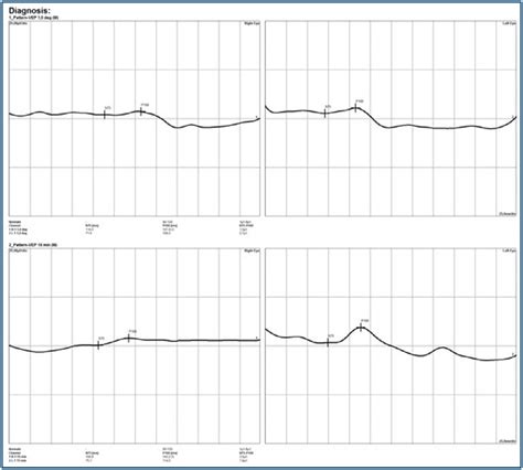 Inferior Temporal Visual Field Defect Inferior Temporal Visual Field Defect