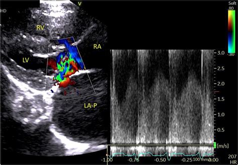 American Society Of Echocardiography On Linkedin Double Outlet Right
