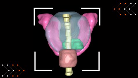 3d Modelling Boosts Prostate Cancer Surgery Success Mirage News