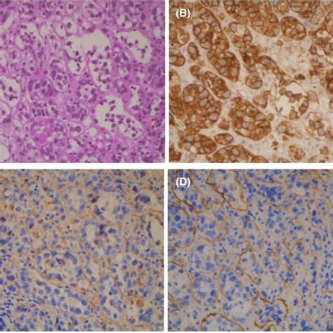 Adrenal Gland Involvement By Intravascular Large B‐cell Lymphoma A