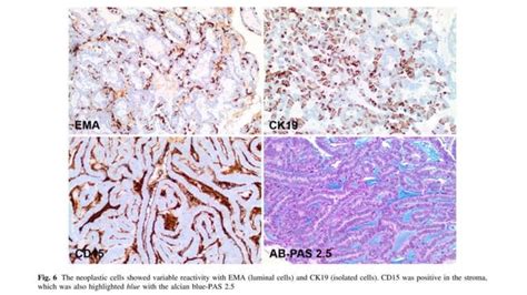 Basal Cell Adenoma And Canalicular Adenoma Doctor Faris Alabeedi Msc