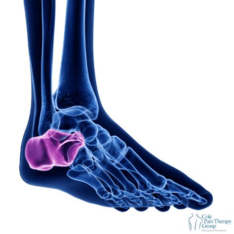 How To Overcome Calcaneal Bursitis And Relieve Heel Pain Cole Pain