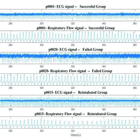 Excerpt Of Ecg And Respiratory Flow Signals From Patients Undergoing Download Scientific