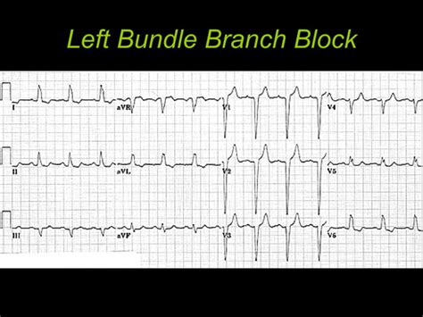 Bundle Branch Blocks PPT Heart And Cardiovascular Diseases Diseases And Conditions