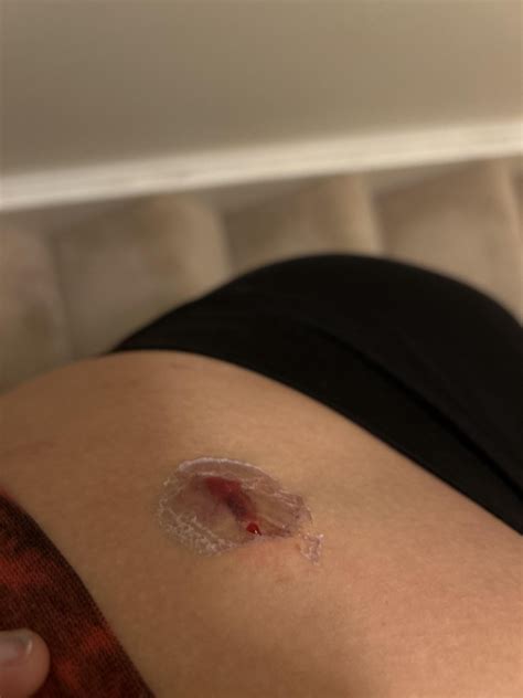 Bleeding Thru Surgical Glue Post Op R Endo