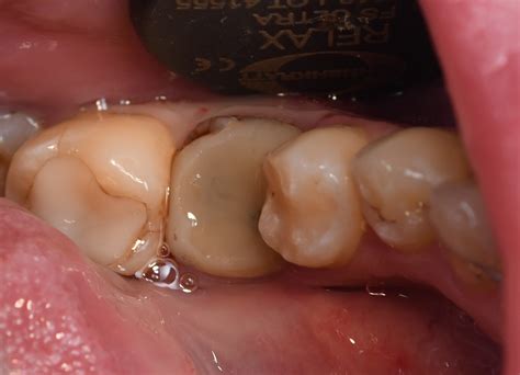Case Study Sealing Socket Abutment Technique Immediate Implant Placement In Molar Site Dsi
