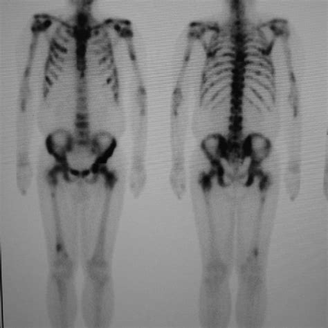 Bone Scintigraphy Findings Bone Scintigraphy Reveals Multiple Bone Download Scientific Diagram