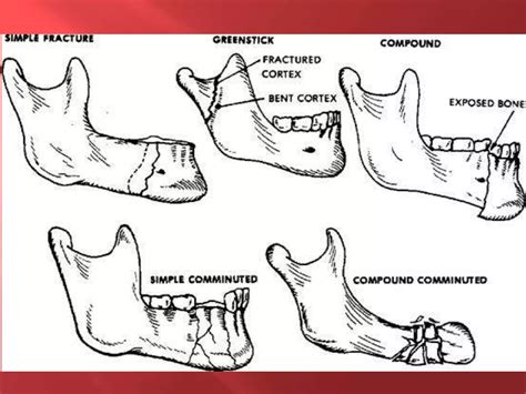 Mandibular Fracture Pptx