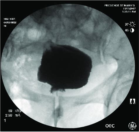 Cystogram Of Bladder Perforation Collected During Cystoscopy Showing Download Scientific