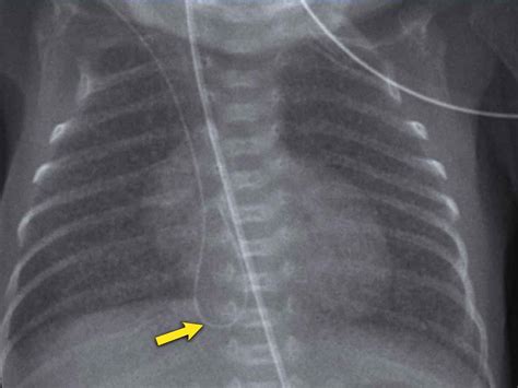 How To Read A Neonatal Chest X Ray At Erin Mackenzie Blog